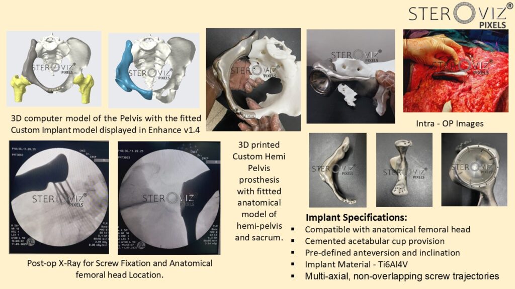 Custom Hemi-Pelvis Implant - Steroviz Pixels