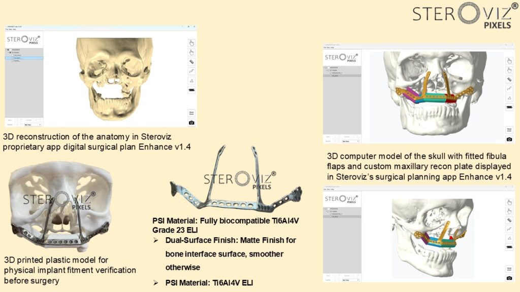 Free Fibula Flap Planning & Maxillary Pre-bent Plate - Steroviz Pixels